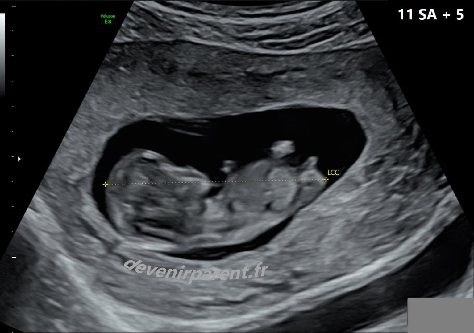 Echographie de datation et écho T1 : késako