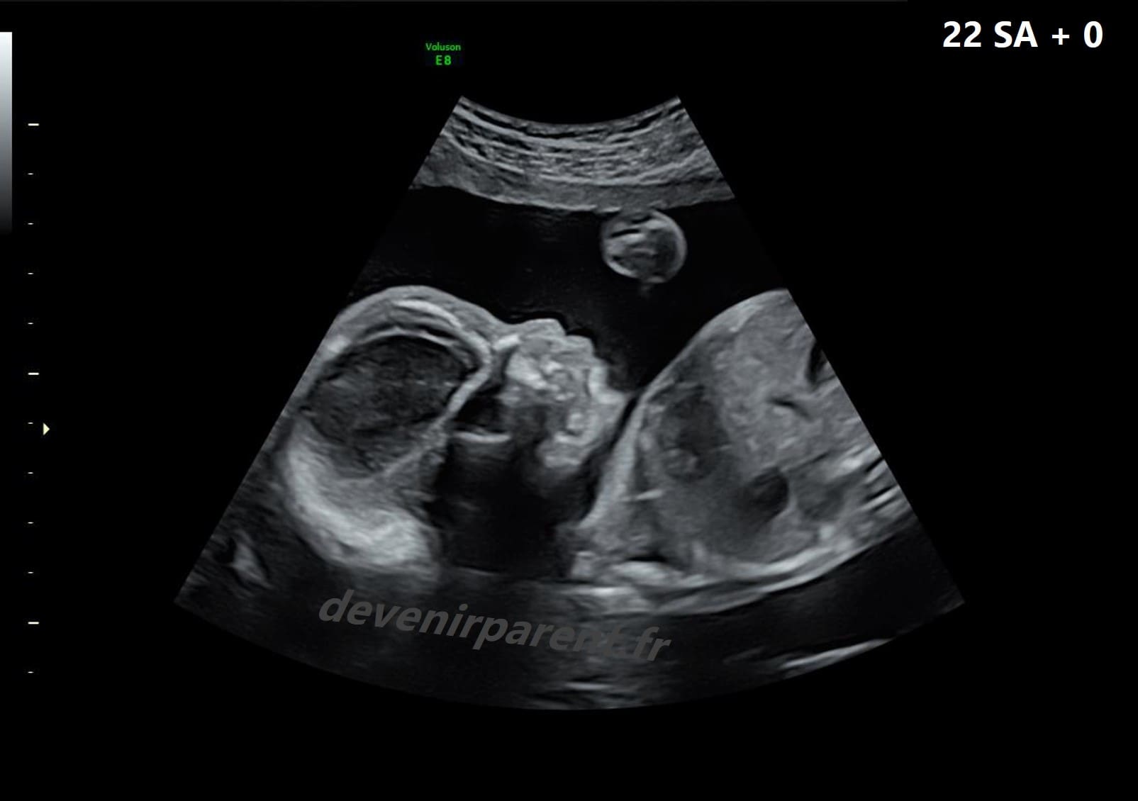 Echo T2 : quand et pour quoi la faire